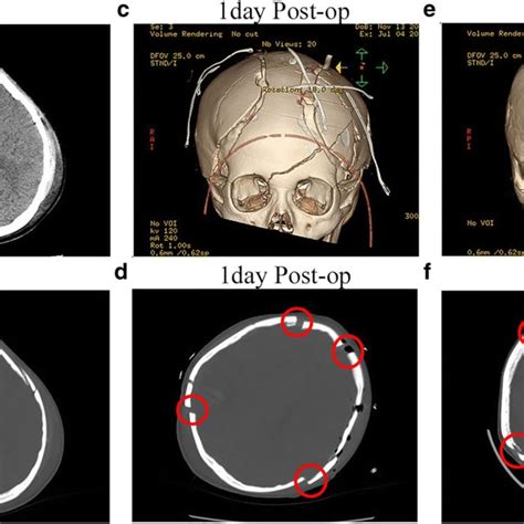 Ct Images Before And After Operation Of One 7 Year Old Patient Who Download Scientific Diagram
