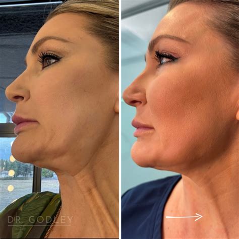 Im Almost 50 And I Tried The Nefertiti Neck Lift With Botox — Godley