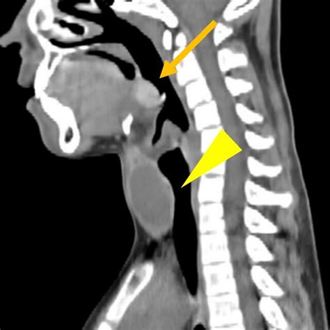Laryngeal Fiberscopy Shows The Mass 4 Cm In The Sublingual Lesion Download Scientific Diagram