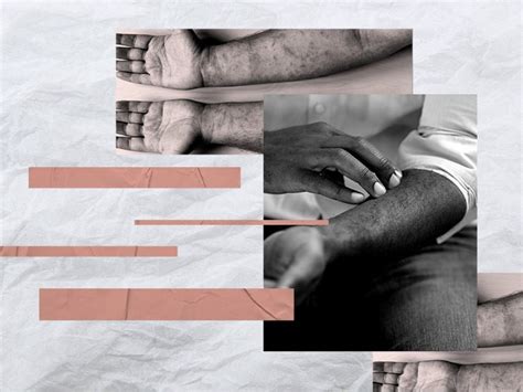 Contact Dermatitis Rash Pictures Treatment And More