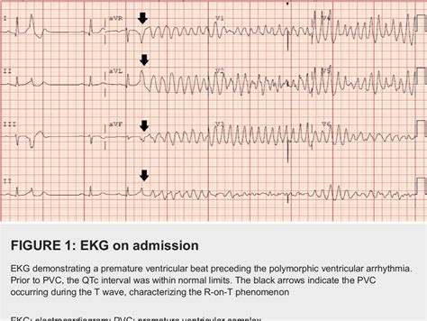 Figure 1 From Presumed Alcohol Induced Ventricular Tachycardia Storm A Case Report Semantic