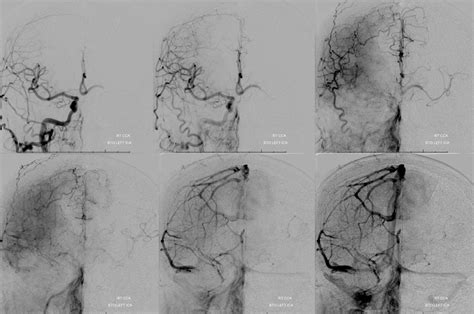 What Is Balloon Occlusion At Sheila Cortes Blog