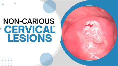 Non Carious Cervical Lesions 4 Types You Should Know Youtube