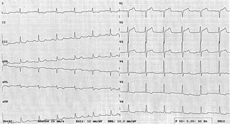 Pseudonormalization Upright T Waves In Leads V2 4 During Angina