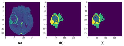 Deep Learning Hybrid Techniques For Brain Tumor Segmentation