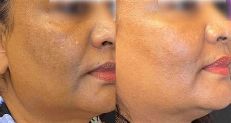 Skin Rejuvenation In Medford Or Pure Medspa