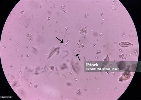 Selsel Ragi Pemula Dalam Urin Pasien Menganalisis Dengan Mikroskop