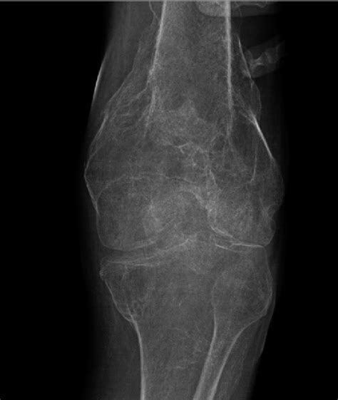 Left Knee X Ray Oblique Externally Rotated Diffuse Bony