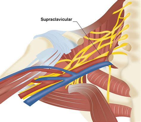 Supraclavicular Brachial Plexus Block Sonoguide