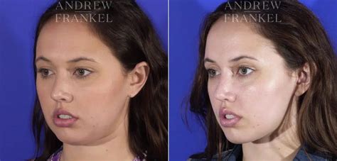 Buccal Fat Removal Results Buccal Fat Removal Azzu