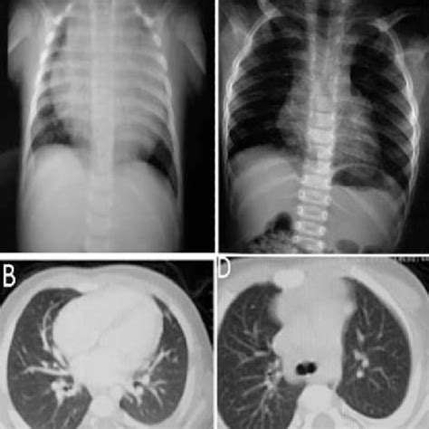 Lung Cat No 1 Diffuse Severe Bronchointerstitial Pattern