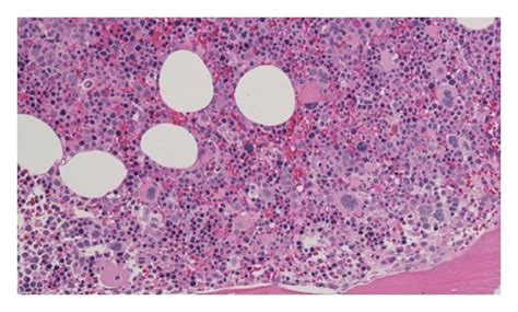 A Hypercellular Bone Marrow With Increase In All Three Hematopoietic