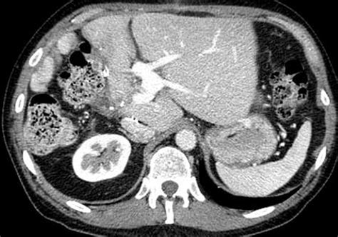 Surgical Resection Of A Malignant Liver Lesion What The Surgeon Wants The Radiologist To Know Ajr Surgical Resection Of A Malignant Liver Lesion What The Surgeon Wants The Radiologist To Know Ajr