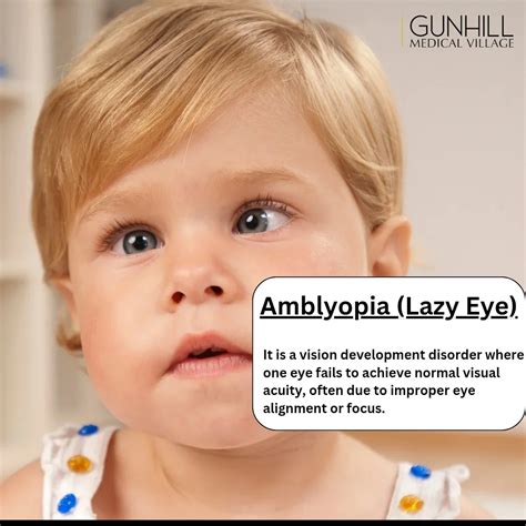 👁️ Understanding Amblyopia Lazy Eye 🌟 Amblyopia Occurs When One Eye