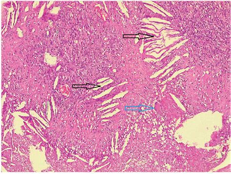 Figure 2 From Testicular Cholesterol Granuloma Mimicking A Testicular