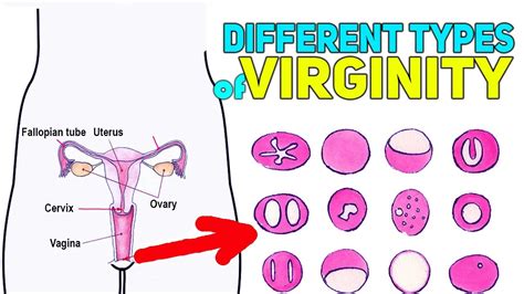 Hymen Variants Overview Types And Treatment Youtube