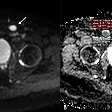 A B Axial T1 And T2 Weighted Images Reveal Bilateral Solid Nodular Download Scientific