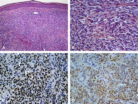 Positive Staining Of Tumor Stage Kaposi Sarcoma With Lymphatic Marker