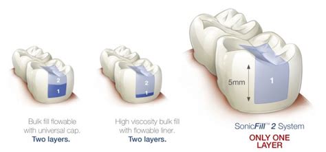 Sonicfill™ 2 Sistema De Resina Bulk Fill Kerr Dental