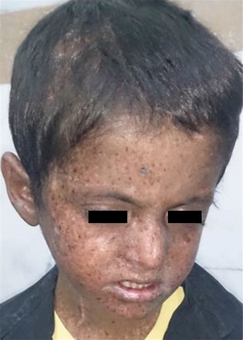 Xeroderma Pigmentosum A Rare Genetic Disease Twins Hide Gare D