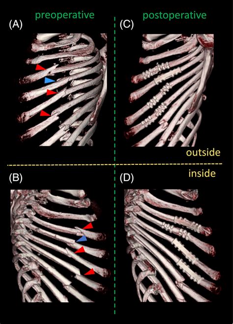 On Preoperative Three‐dimensional Computed Tomography A B Crossed Download Scientific