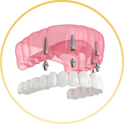 Home Apex Oral Surgery And Implant Center