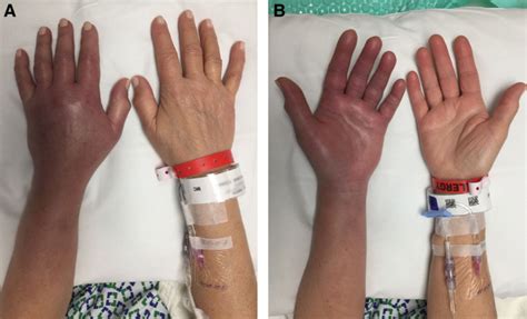 Acute Superficial Vein Thrombosis Of The Upper Extremity A Case Report