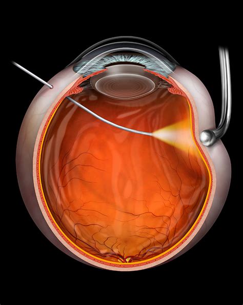 Scleral Depression In Vitreo Retinal Surgery By Mark Erickson