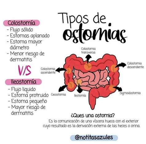 Tipos De Ostomias YUDOC ORG UDocz Tipos De Ostomias YUDOC ORG UDocz