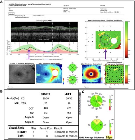 Comparison Between The Recommendations Of Glaucoma Specialists And Oct