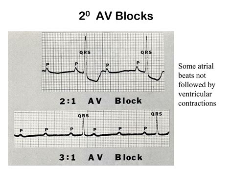 Ppt Expert Guide To Ekg Interpretation Rate Rhythm Hypertrophy
