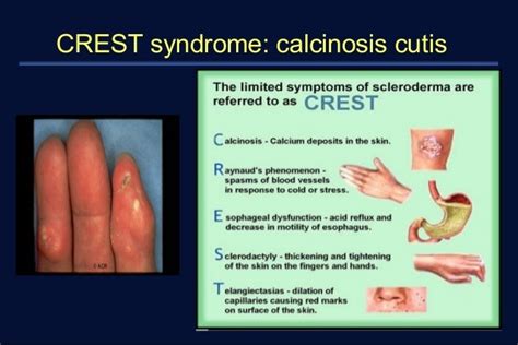 Med R Scleroderma