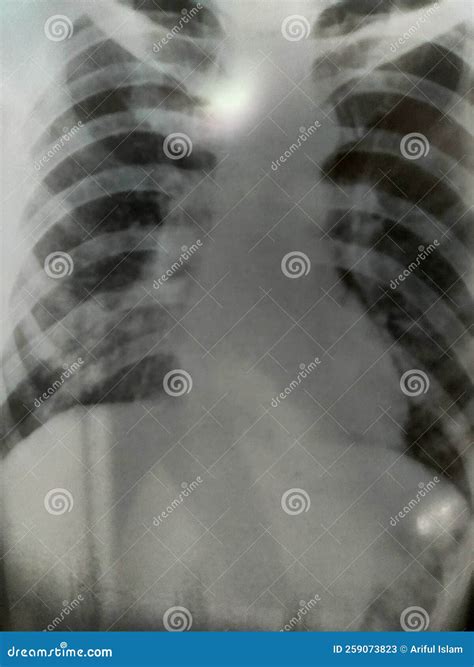 Chest X Rays Show Advanced Pulmonary Tuberculosis Royalty Free Stock Photo Cartoondealer