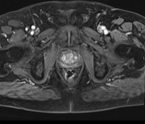 Screening For Prostate Cancer Using Biparametric Bp Mri Prostate Matters