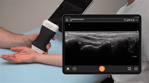 Ultrasound Of The Scaphoid Bone Clarius