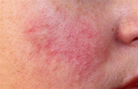 Recent Advances In Understanding And Managing Rosacea Page 2 Of 2