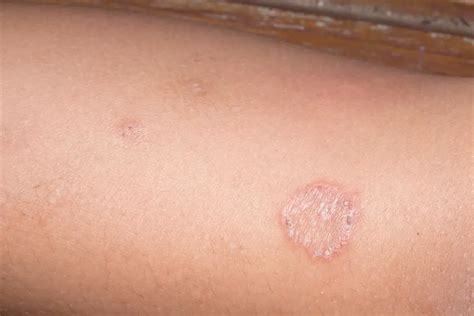 What Viral Rash Looks Like Ringworm At Keith Turner Blog