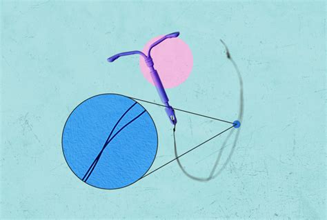 Why Its Important To Check Your Iud Strings