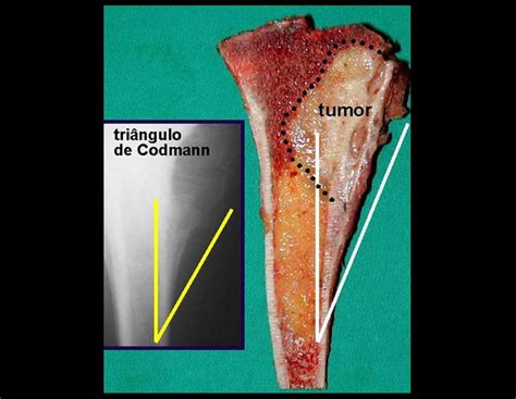 Osteosarcoma Oncosurgery