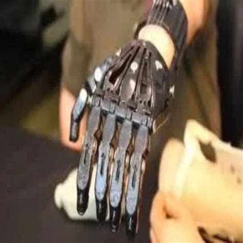 Ilimb Myoelectric Prosthetic Hand For Personal Below The Elbow At