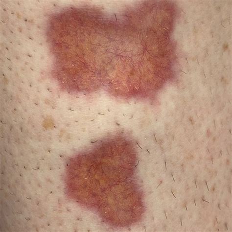 Well Circumscribed Erythematous Atrophic Telangiectatic Plaques On