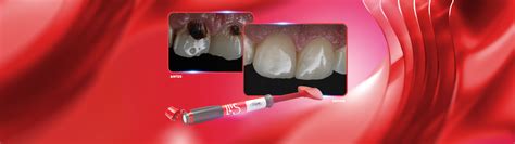 Direct Composite Class V Restorations Fgm Dental Group