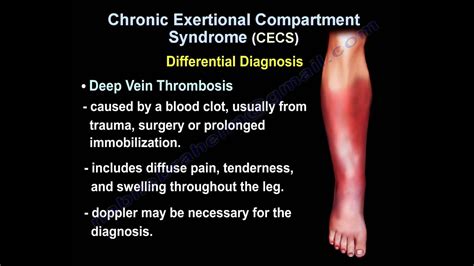 Compartment Syndrome Hand Icd 10 Code At Russell Erik Blog