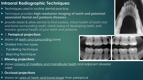 Bisecting Angle Technique Radiology Ppt Pptx