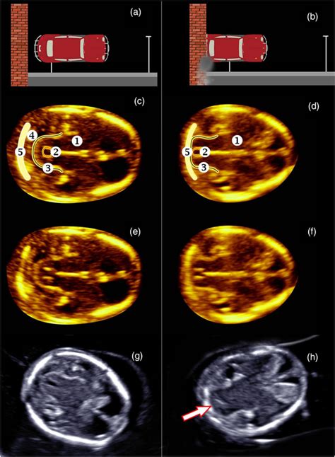 Crash Sign A First Trimester Sonographic Marker Of Spina Bifida Download Scientific Diagram