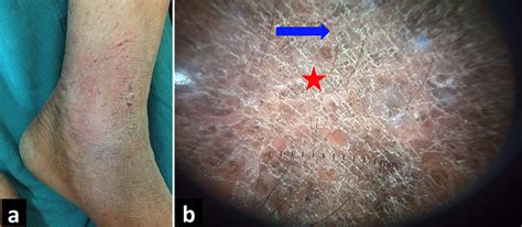 Dermoscopy In Eczema A Magnified Approach To Diagnosis And Management