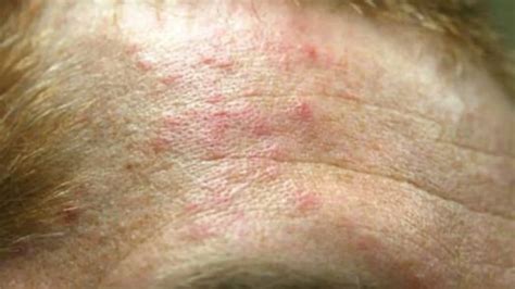 Bed Bug Bites On Different Body Parts Arm Back Face Legs