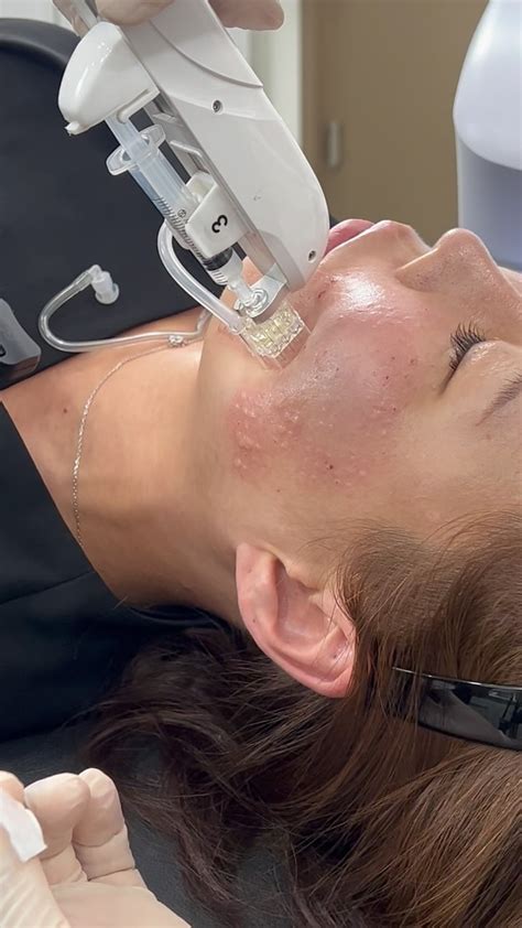 유앤미클리닉 강남본점 실리프팅 이마필러 얼굴형교정 인중축소 유앤미 직원들도 겨울 대비 피부관리 시작🌟 쥬베룩스킨부스터는 얇은 니들을 통해 진피층에 촘촘하기 주입하여