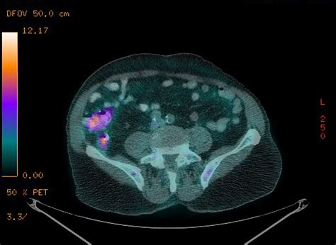 Appendix Cancer Other Imaging Findings Wikidoc