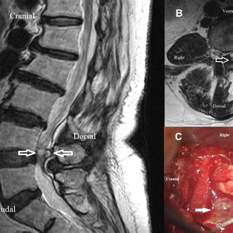 Summary Of Reported Cases Of Lumbar Intraspinal Cppd Download Scientific Diagram